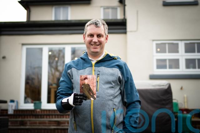Bionic arms which can mimic hand movements to be made available on NHS ...